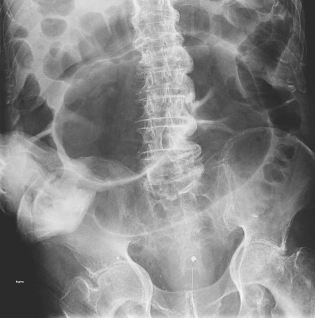 Vólvulo cecal :: Imagenologosecuador